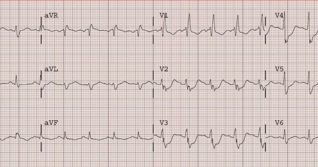 Dr. Smith's ECG Blog: Posterior ST Elevation MI in the Setting of Right ...