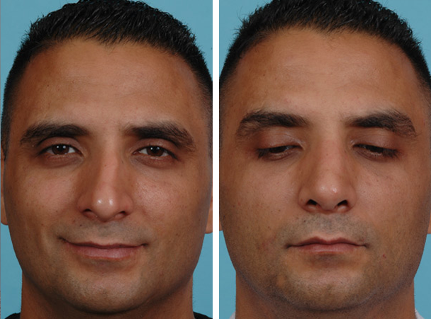 Medical Treatment Pictures-for Better Understanding: Septoplasty ...
