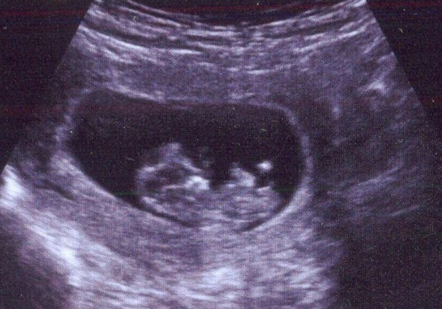 Something More...: It's a Fetus!