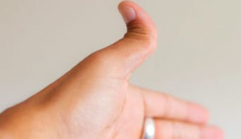 Questioning Answers: Joint hypermobility