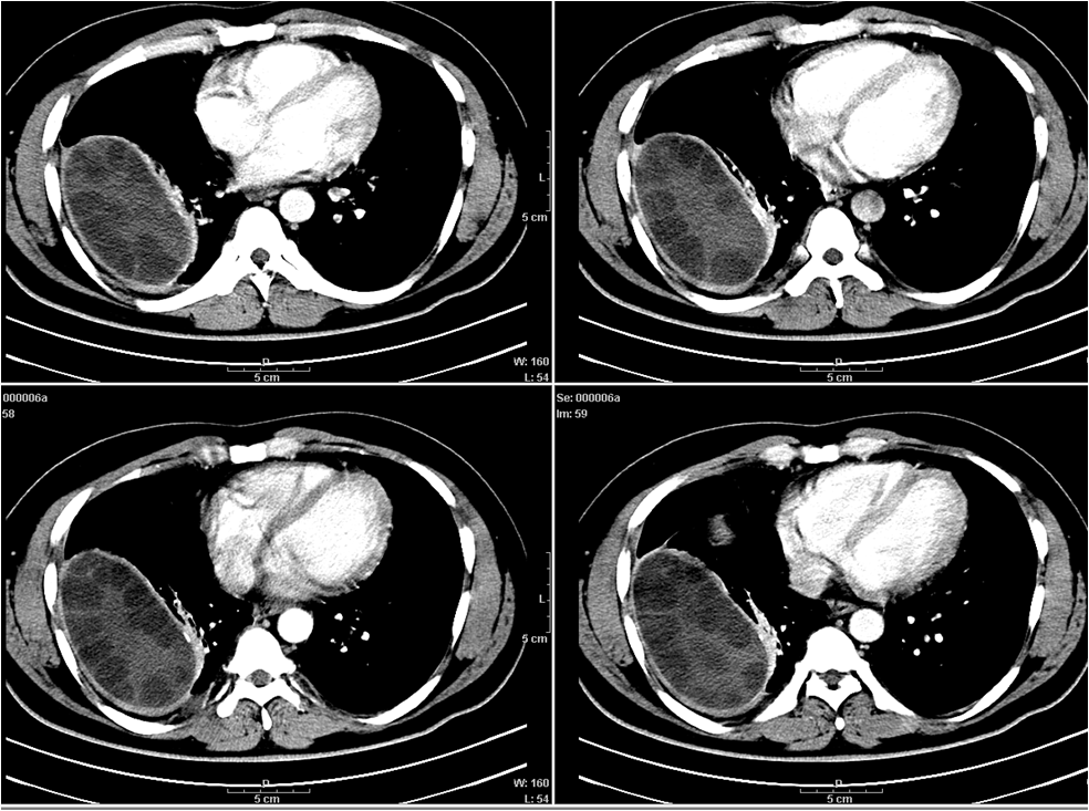 RADIOLOGY IMAGE SPOTTERS: Hydatid cyst lung