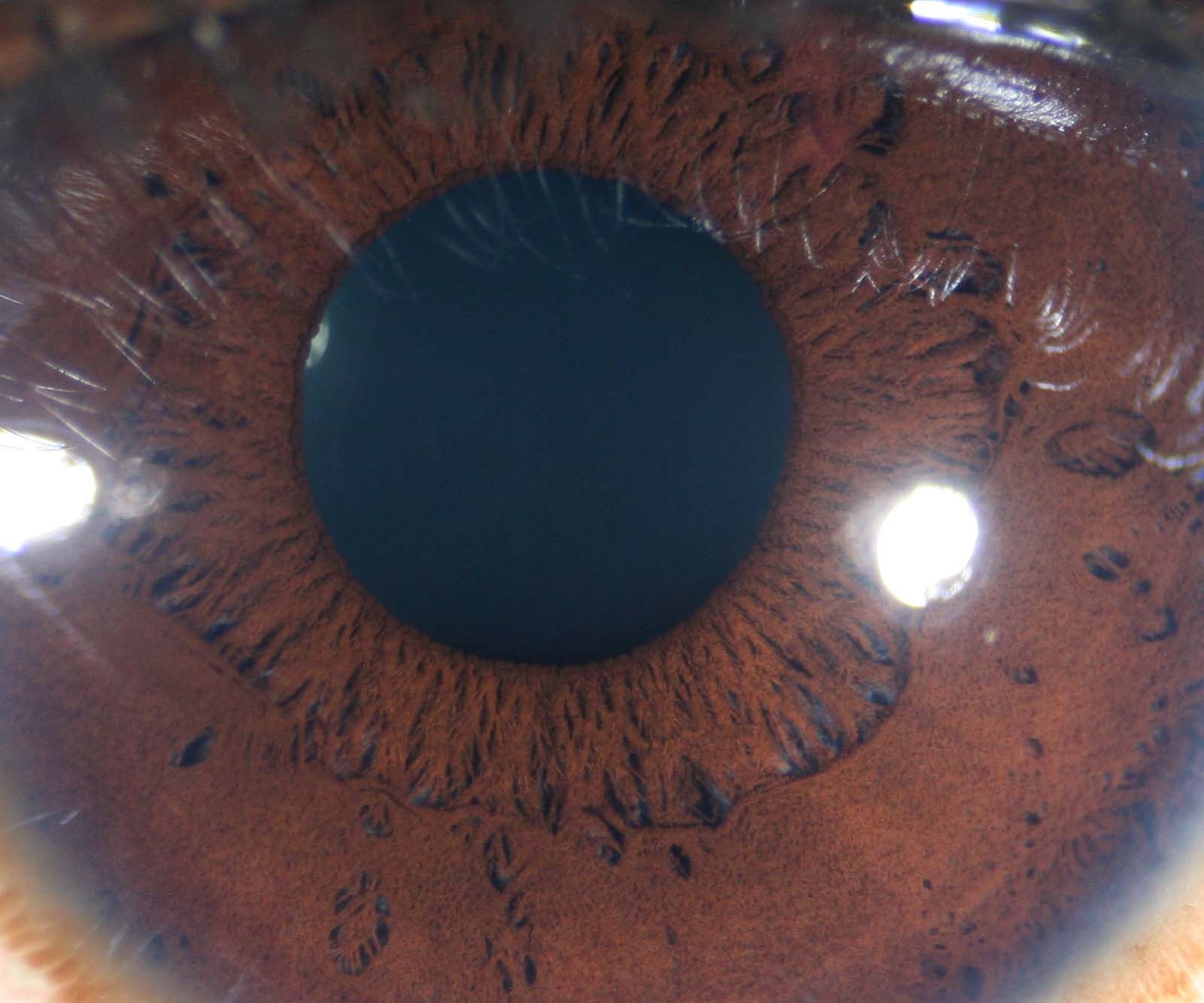 Modern & Multidimensional Iridology: Crypts at External Border of the ...