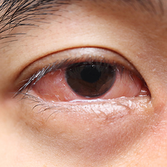 Conjunctivitis Treatment And 4 Types ~ Stay Healthy
