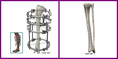 Journal Of A Princess..: Autologous Conditioned Plasma (ACP) Injection