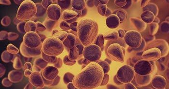 Ciri-Ciri Leukemia Stadium 1-4