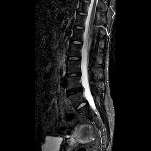 MRI Vertebrae Lumbar In Patient low back pain - Radiology Imaging