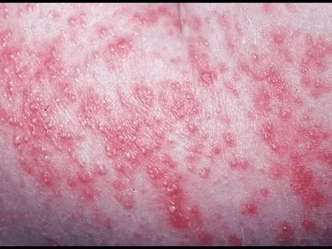 Know how cause infection symptom yeast 2016! - PERSONAL INJURY LAWYER