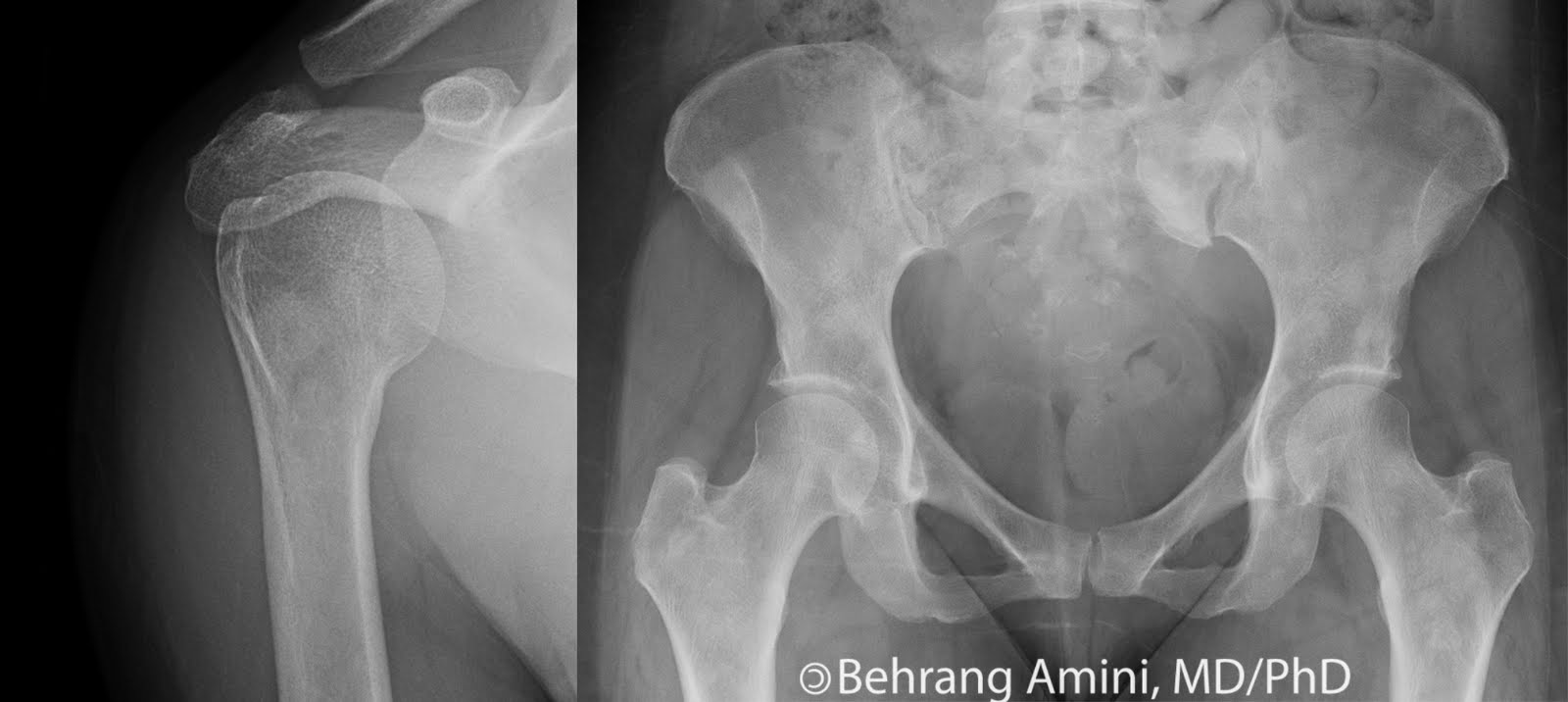 Roentgen Ray Reader: POEMS Syndrome