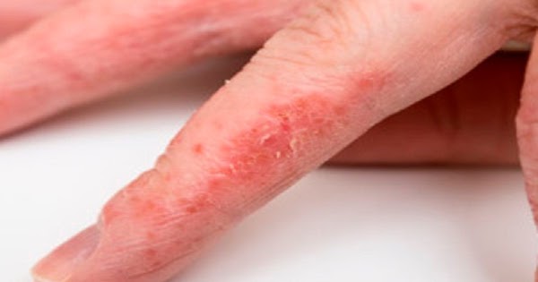 Disidrose - O que é e como tratar? - Saúde & Conhecimento