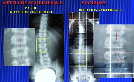 Un médecin du sport vous informe: Scolioses structurales idiopathiques ...