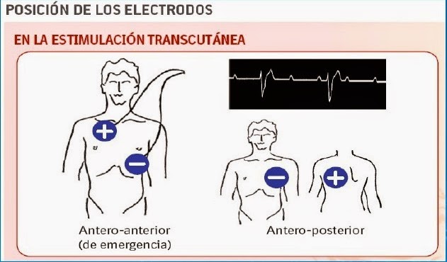 Enfermer@ en Urgencias y UCI : Marcapasos Temporal
