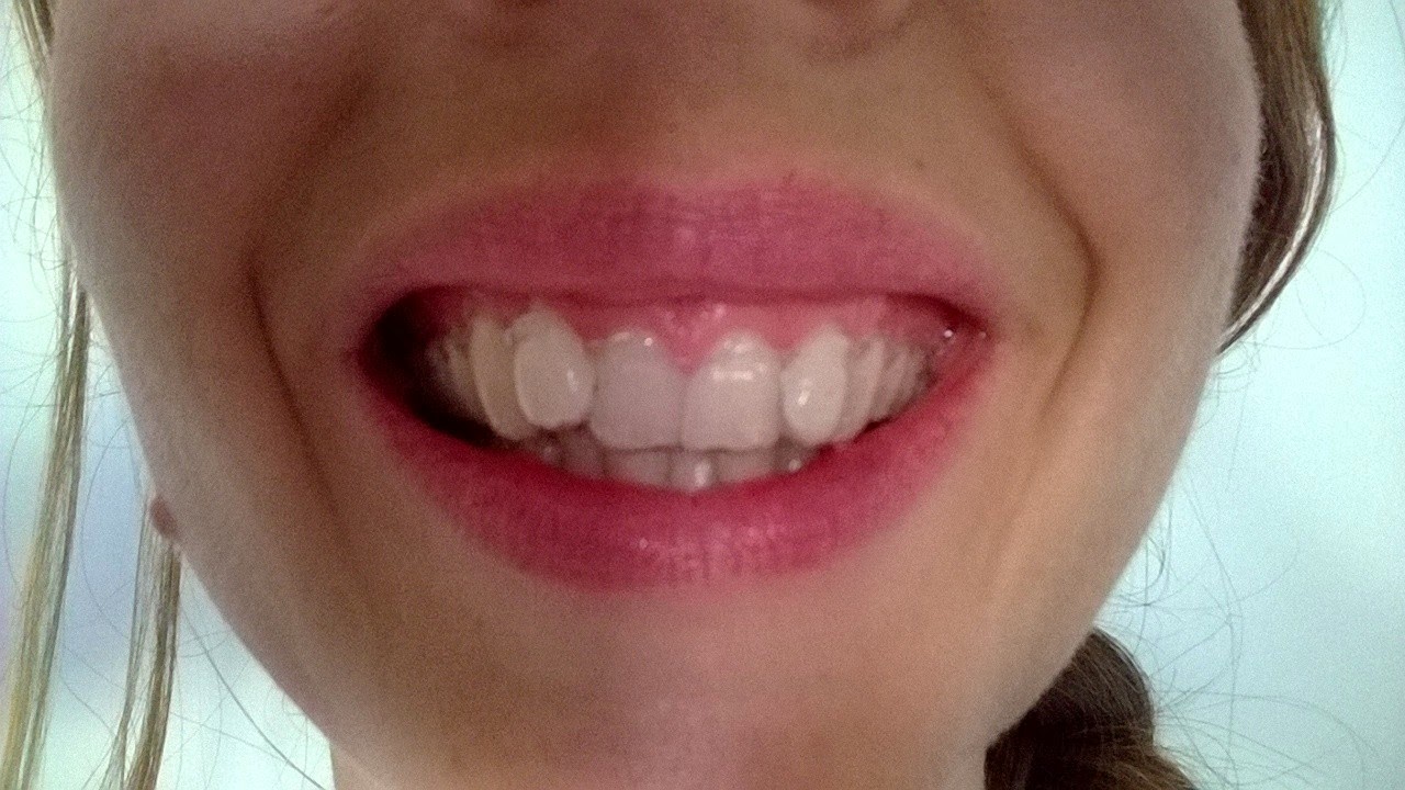 Villafienepien: Invisalign start beugel #1