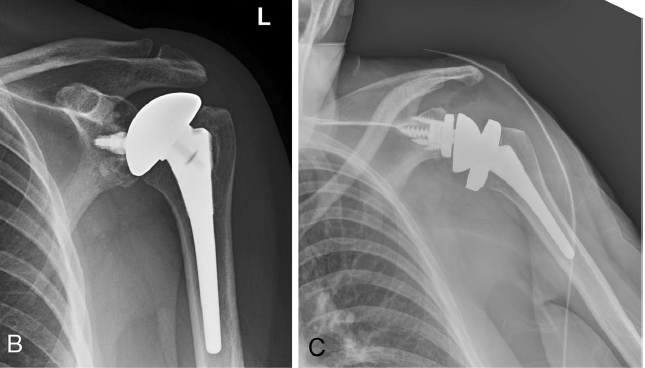 Shoulder Arthritis / Joint Replacement : Platform systems in shoulder ...