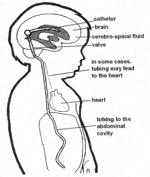 LOONEY LUNA'S PAGE!!!!: entry #2 Hydrocephalus in children