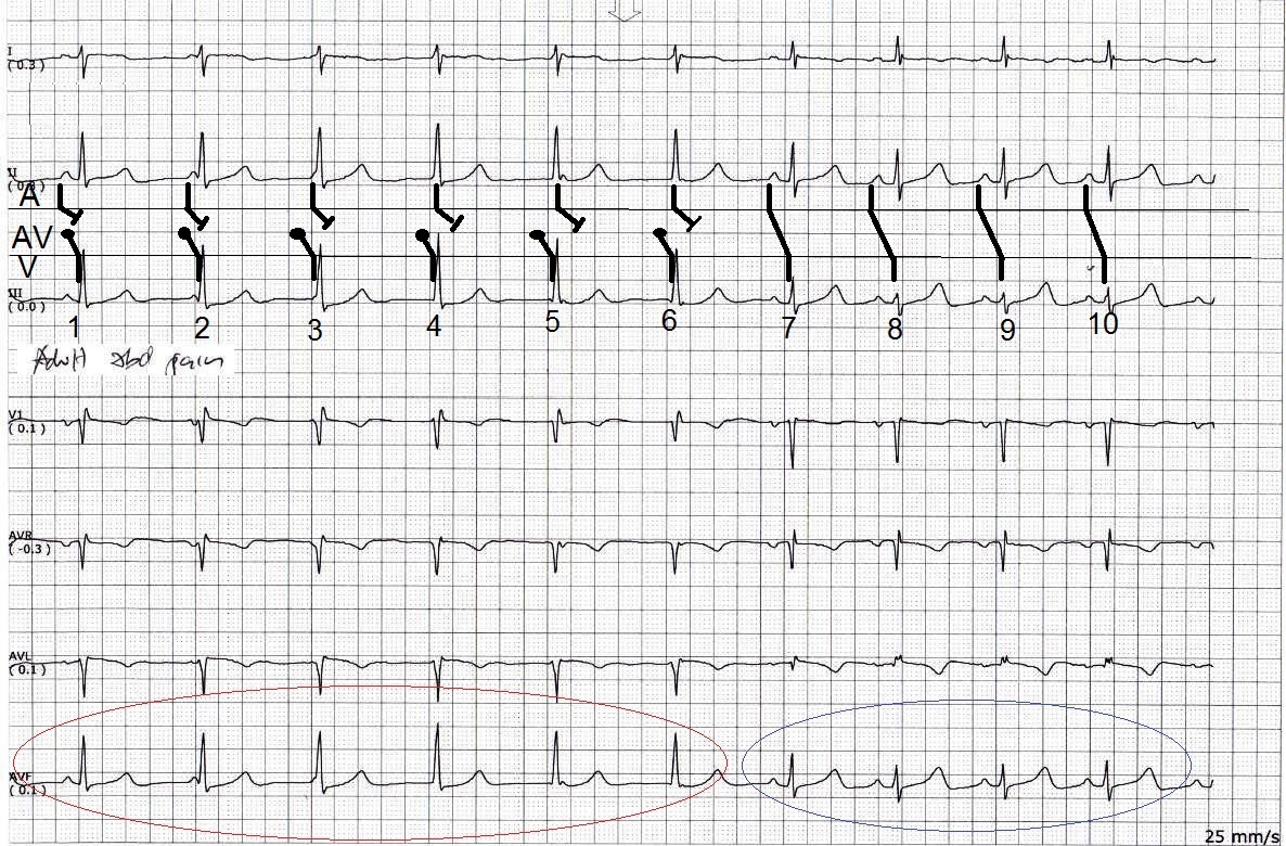 ECG Rhythms: Isorhythmic AV dissociation