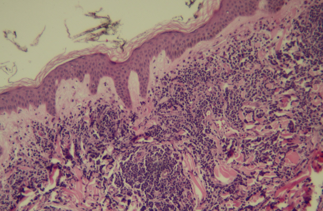 Dermpath Made Simple - Neoplastic: Skin Stains