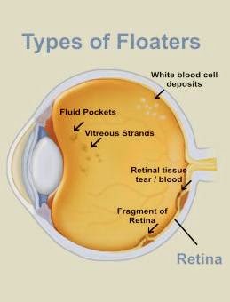 EYE FLOATERS