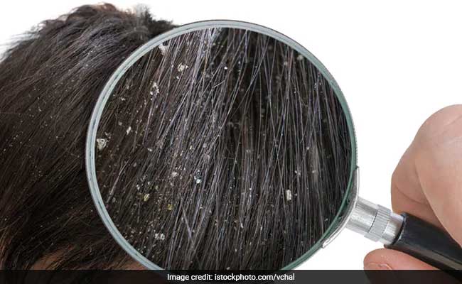 A Simple Yet Effective Home Remedy That Can Help Keep Dandruff Issues ...