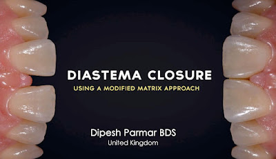 OPERATIVE DENTISTRY: Diastema Closure Perfection - Using a modified ...