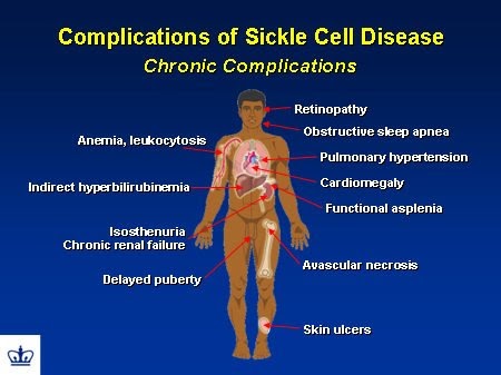 Medical Adda: Complications of Sickle cell disease...