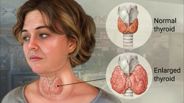 Understanding Goiter -- The Basics