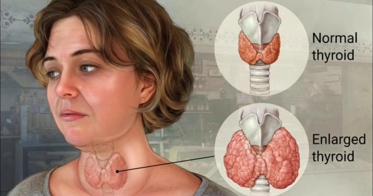 Understanding Goiter -- The Basics