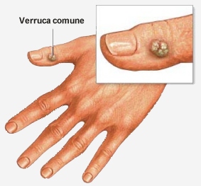 Dr Domenico Cimino - Pediatra: Le verruche