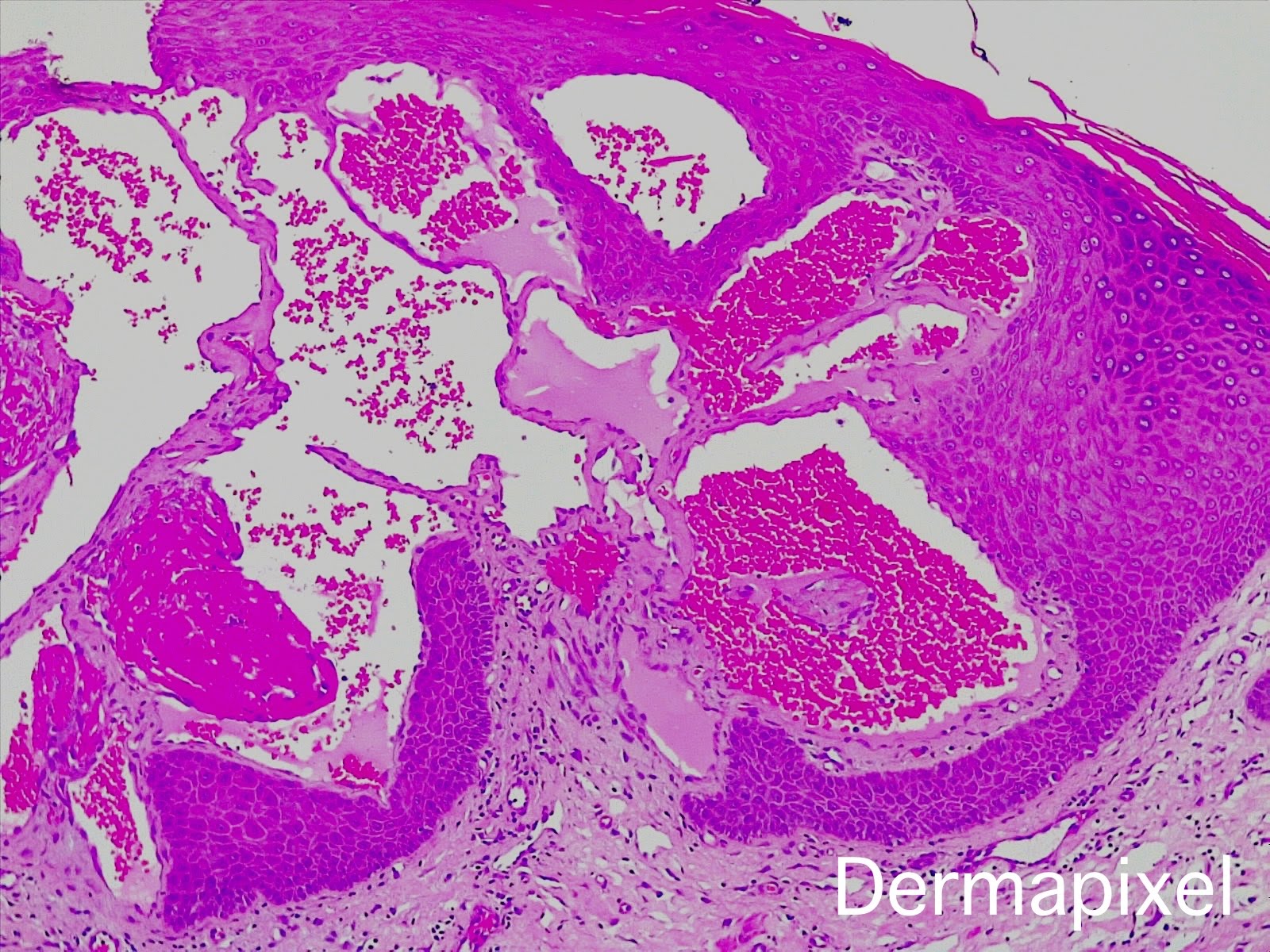 Angioqueratoma De Fordyce Tratamiento at Carole Spears blog