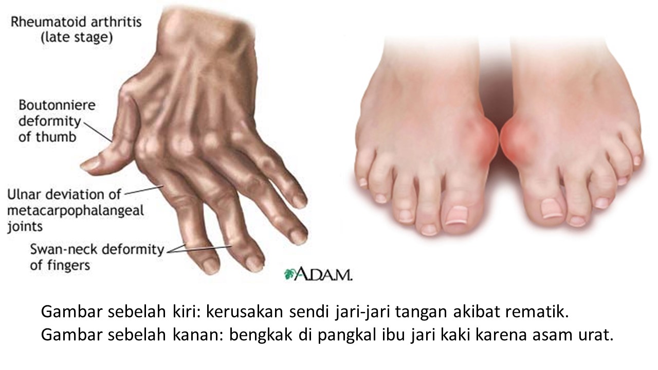 Nyeri Otot-Sendi & Cedera Olahraga. Kenapa Bisa Terjadi dan Apa yang ...