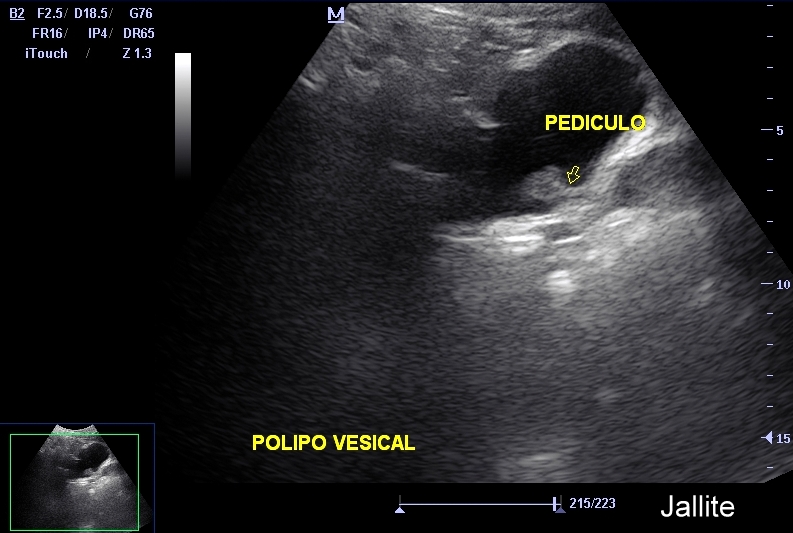 Pólipo Vesical