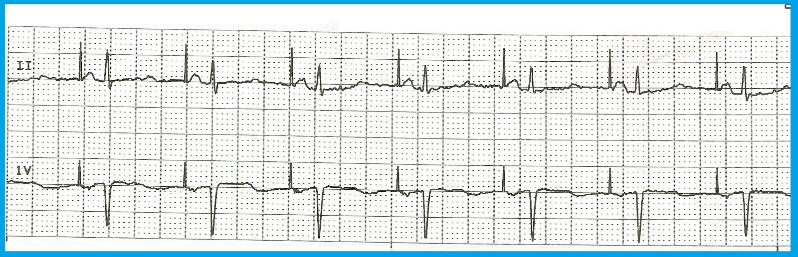 ECG Rhythm Strip Quiz 116