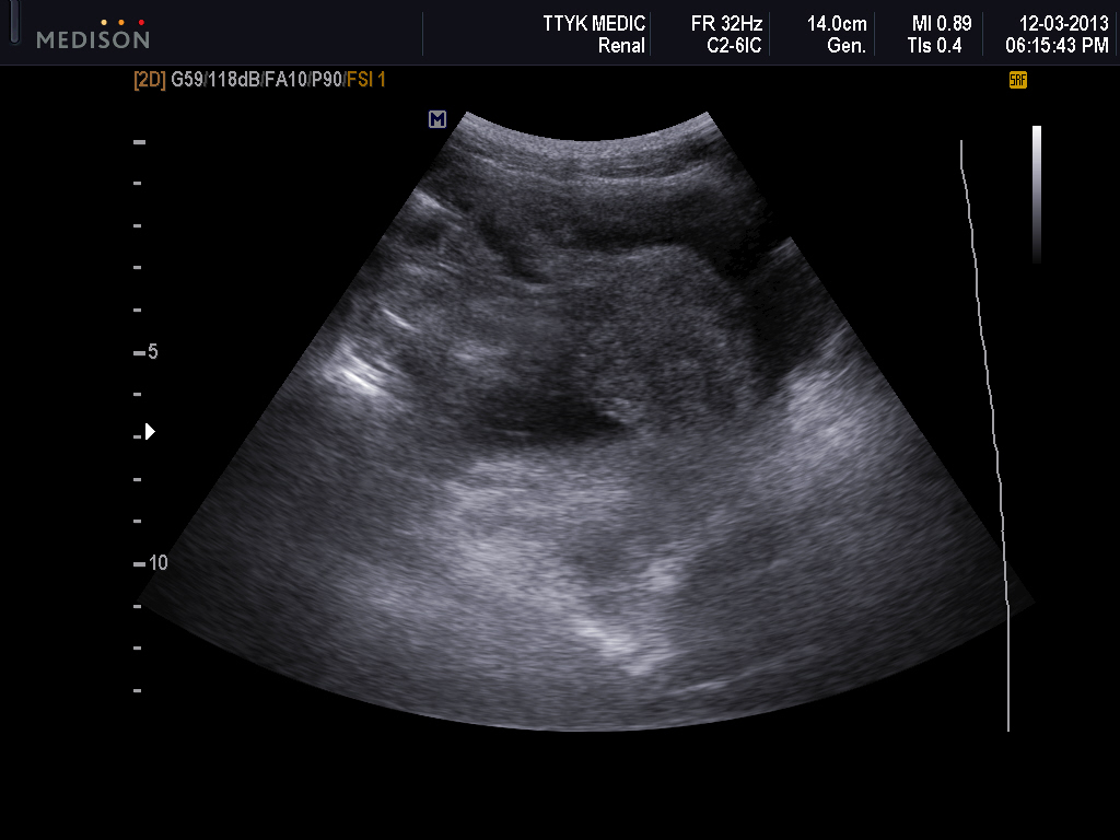 VIETNAMESE MEDIC ULTRASOUND: CASE 171: THICKENING OF ANTRUM WALL, Dr ...