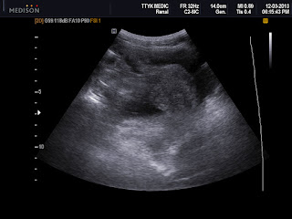 VIETNAMESE MEDIC ULTRASOUND: CASE 171: THICKENING OF ANTRUM WALL, Dr ...