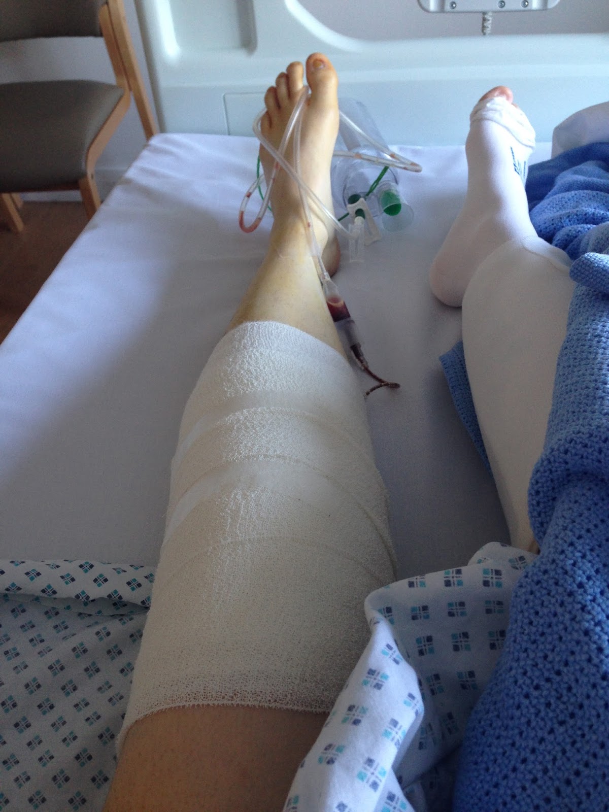 My Experience Having MPFL Reconstruction Surgery