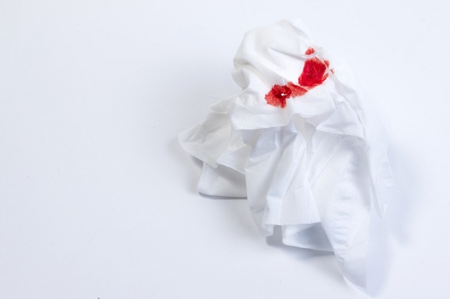 Tak Perlu Panik, Kenali Penyebab Ingus Berdarah Dan Cara Mengatasinya ...