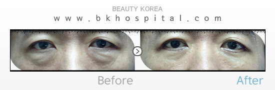 Eyelid Surgery Legend Dr. Kim Byung Gun: [BK Plastic Surgery Hospital] Fat & Saggy Lower Eyelids ...