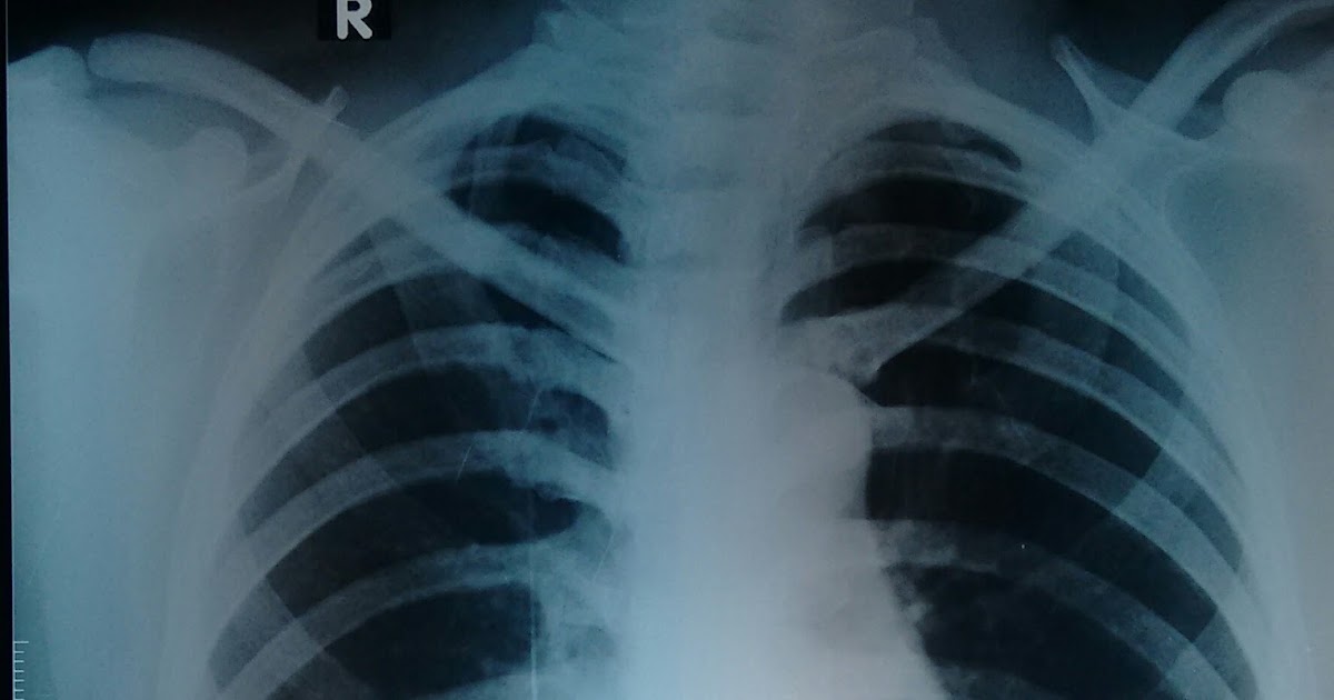 Chest Medicine Made Easy-Dr Deepu: The cervical rib