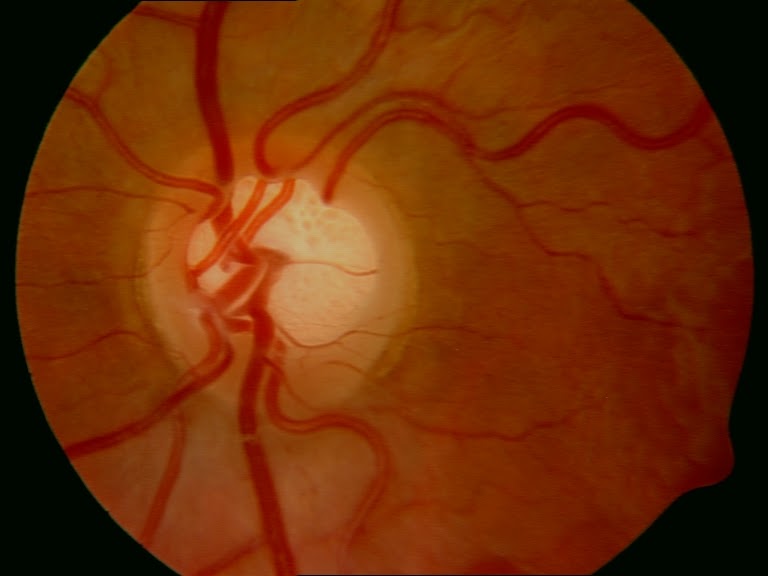 zonaprofesional: Papila Sana Vs Papila Patológica