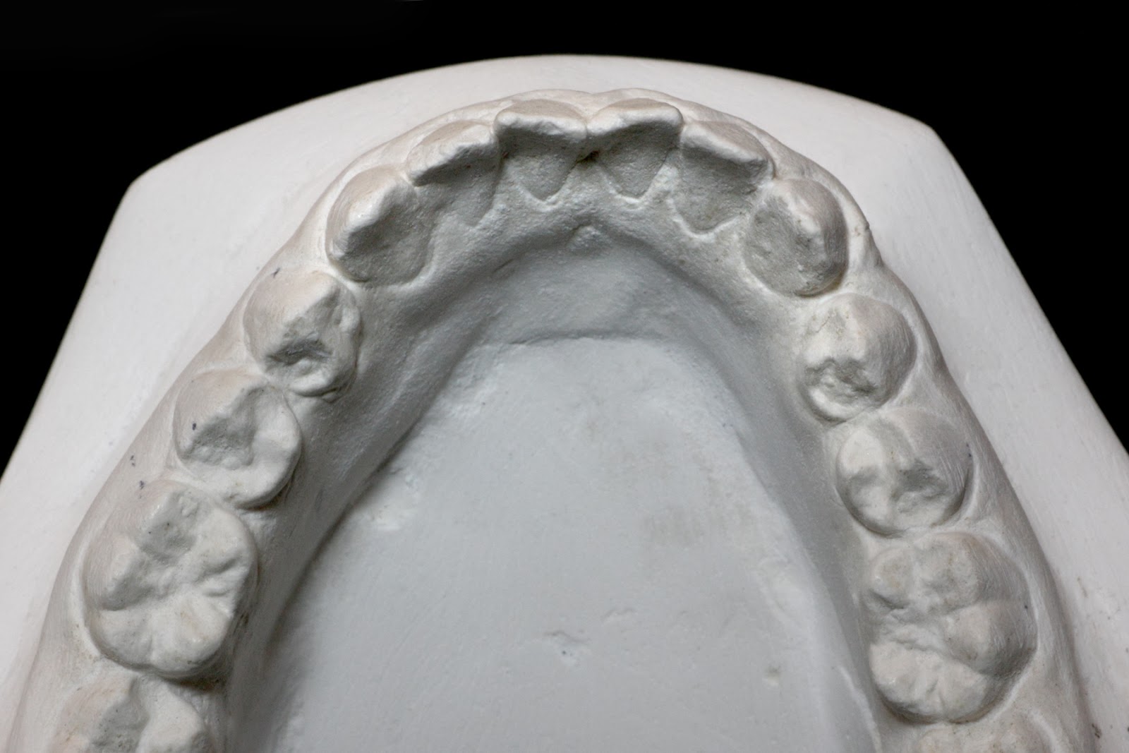 Orthodontics: UG Model Analysis Position of teeth