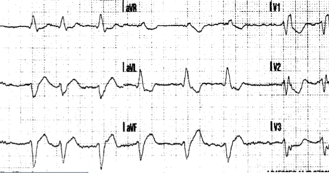 Dr. Smith's ECG Blog: Chest pain and Concordant ST Depression in a ...
