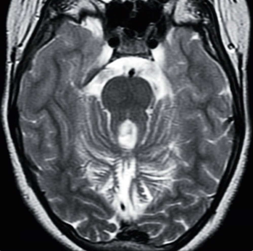 Molar Tooth Malformations (Joubert)