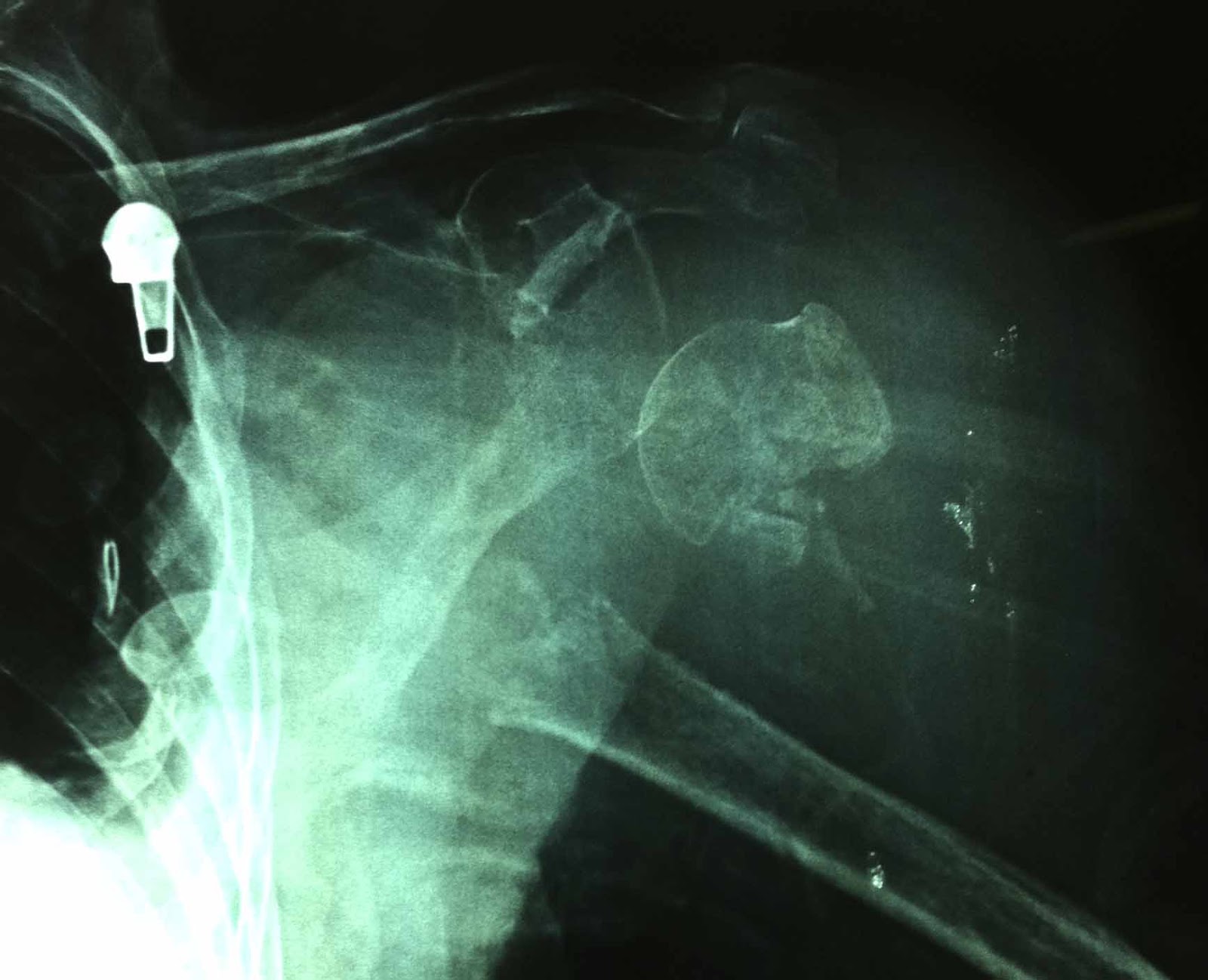 O R T O C R I T I C A: Fractura luxacion de cabeza humeral no reciente ...