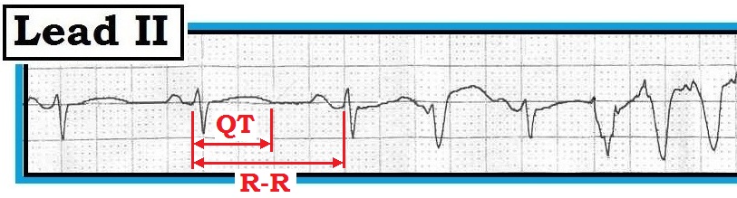 ECG Interpretation: ECG Interpretation Review #36: (WCT - VT - A Fib ...