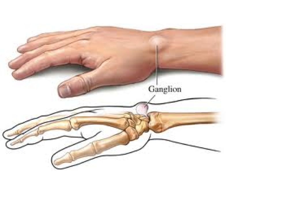 Dr. Marcelo Yanagiura Gomes: Cistos Sinoviais