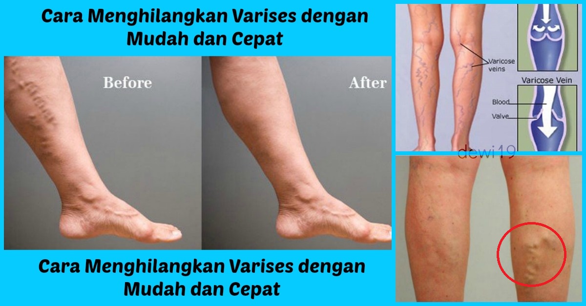 Huh Kesel Banget Kan Muncul Varises di Kaki ?? Jangan Takut Inilah 2 ...