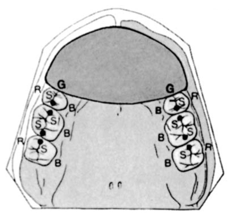 PMF Víctor Orduña: CLASIFICACIÓN DE DEFECTOS MAXILARES POSTQUIRÚRGICOS ...