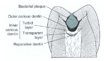 Histopatologi Karies Dentin | Logbook Calon DRG