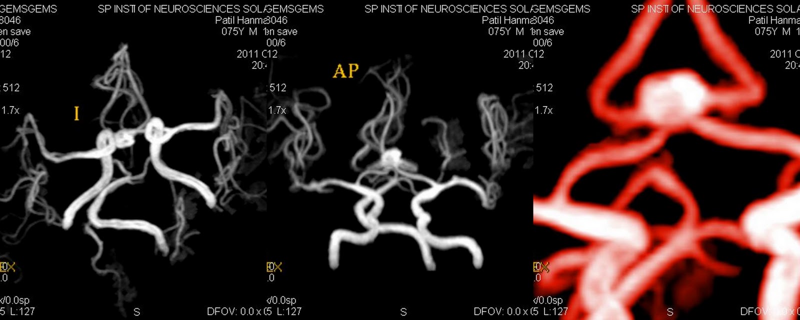 Dr Balaji Anvekar FRCR: Acom Aneurysm