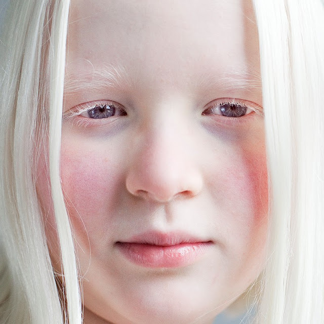 Albinism | Health articles for healthy living