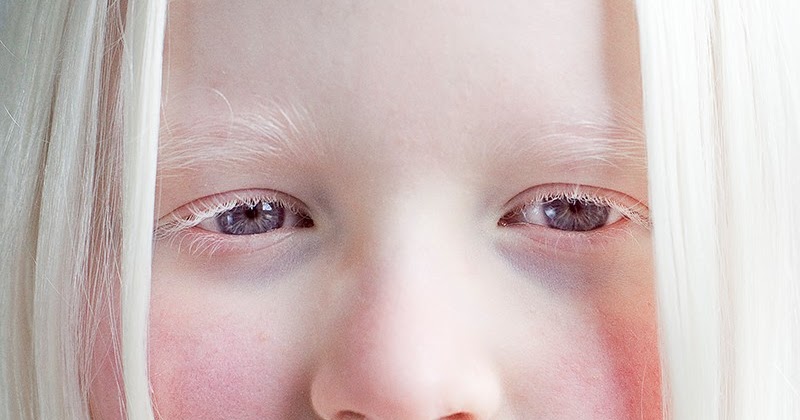 Albinism | Health articles for healthy living